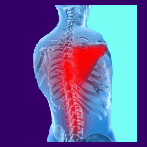 Back Muscle Injury - Back Pain
