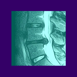 Back Pain MRI - Back Pain
