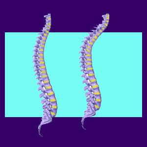 Backbone - Back Pain