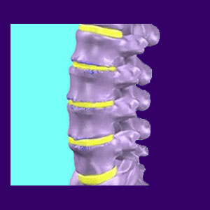Bone Spurs - Back Pain