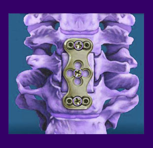 Corpectomy - Back Pain