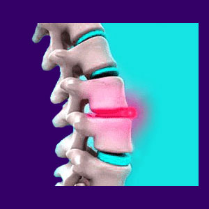 Discogenic Pain - Back Pain