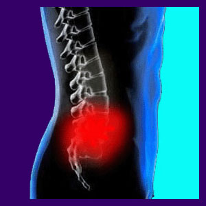 Facet Hypertrophy - Back Pain