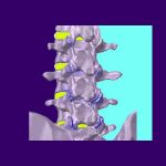 Facet Rhizotomy - Back Pain