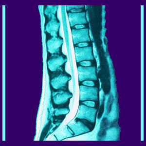 Hydromyelia - Back Pain