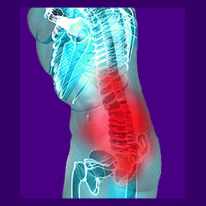 Hyperlordosis - Back Pain