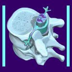 Lateral Recess Stenosis - Back Pain
