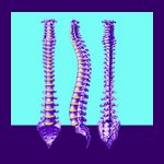 Listhesis - Back Pain