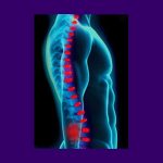 Lumbar Facet Syndrome - Back Pain