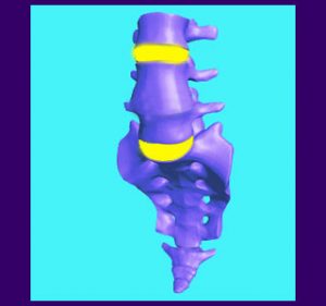 Naturally Fused Vertebrae - Back Pain