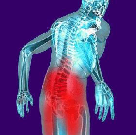 Neurogenic Intermittent Claudication - Back Pain