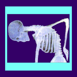 Nutritional Kyphosis - Back Pain