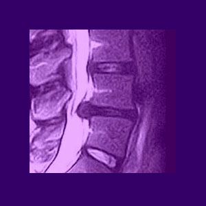 Ruptured Discs - Back Pain