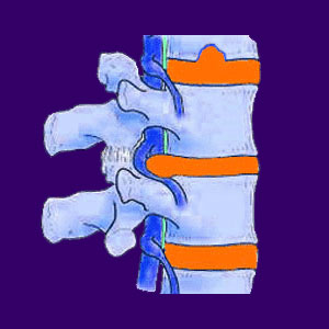 Schmorl's Node - Back Pain