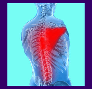 Spinal Cord Stroke - Back Pain
