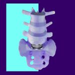 Spinal Implants - Back Pain