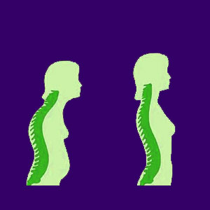 Sway Back - Back Pain