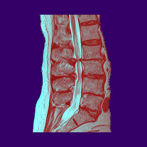 Syringomyelia - Back Pain