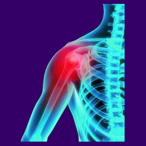 Tendonitis - Back Pain