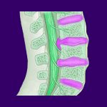 Thecal Sac Impingement - Back Pain