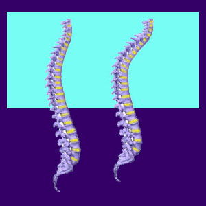 Vertebral Wedging - Back Pain
